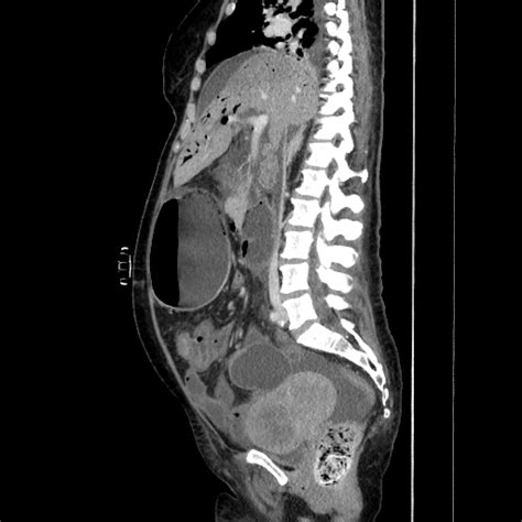 Fileesophageal And Gastric Pneumatosis Portal Venous Gas Radiopaedia