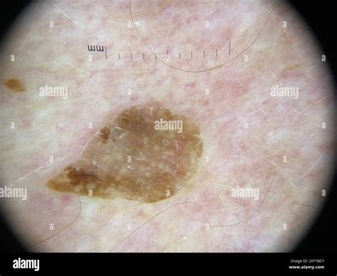Dermatoscope Image Of A Seborrheic Keratosis On The Back Of A 68 Year