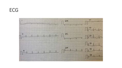 Chronic Constrictive Pericarditis Ideal Short Case Presentation Ppt