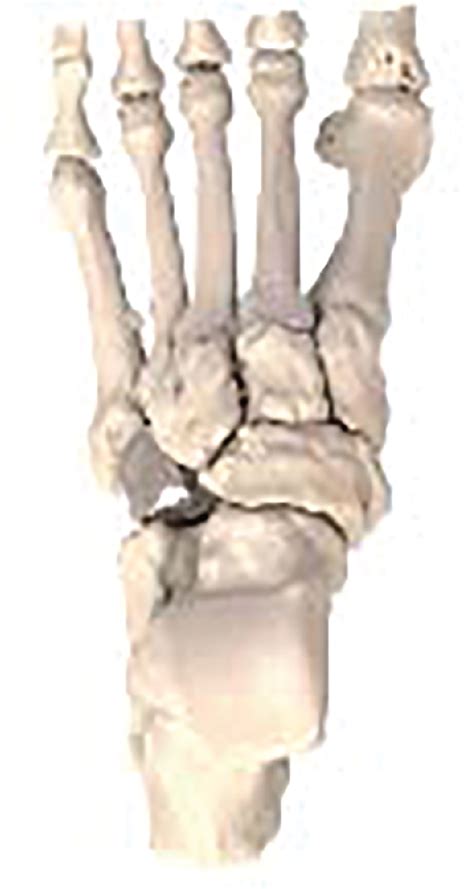 3d Printed Total Cuboid Replacement For Lateral Column Pathology