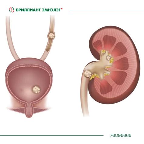 Бриллиант 📌Бөөр шээсний зам чулуужих өвчин Urolithiasis Шинж тэмдэг Өвдөлт гэнэт хүчтэй