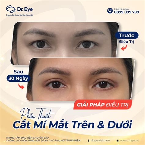 Mắt Nai Là Gì Tốt Hay Xấu Cách Sở Hữu Mắt Nai đẹp Như ý
