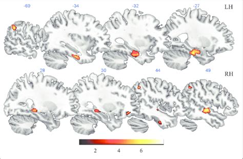 Results Of The Voxel Based Morphometry Analysis Red To Yellow Patches Download Scientific