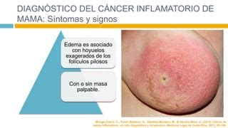 Cáncer de mama inflamatorio PPT