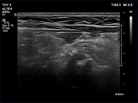 Multinodular Goiter Ultrasound Goiter Nontoxic Thyroid Gland