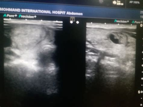 Haroon Khan On Linkedin Multiple Colloid Nodules With Single Solid Nodule In Both Thyroid…