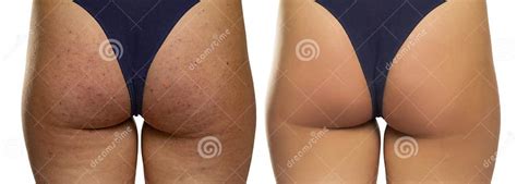 Nalgas Femeninas Antes Y Después Del Tratamiento Foto De Archivo