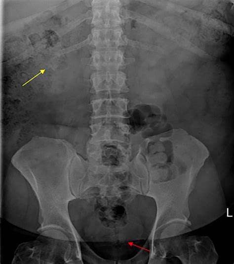 Left Vesicoureteral Junction Stone And The Right Staghorn Stone