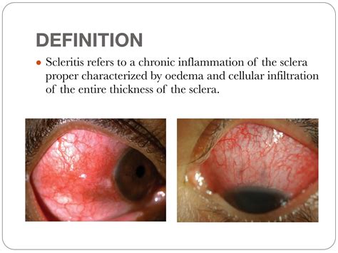 Scleritis Various Presentations Investigations And Treatment