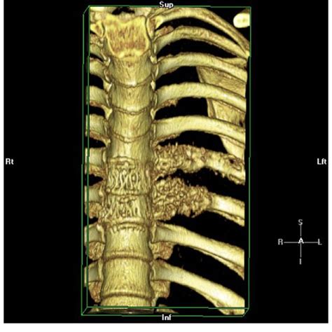 Pdf Epithelioid Hemangioma Of The Spine An Uncommon Cause Of Spinal