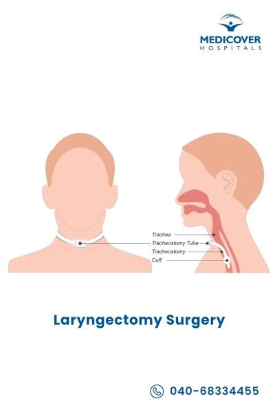 Laryngectomy Procedure Benefits Risks And Recovery