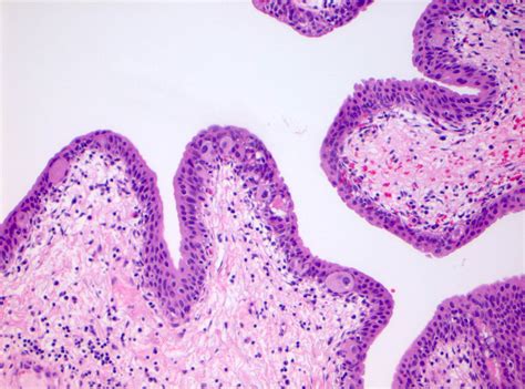 Pathology Outlines Carcinoma In Situ