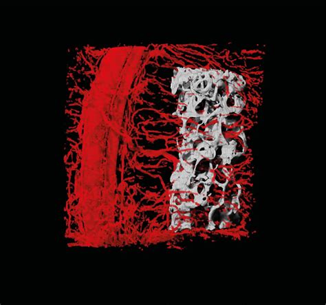 Success In Creating An Engineered Implant That Replaces Damaged Bone