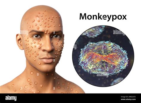 Monkeypox Infection Illustration Stock Photo Alamy