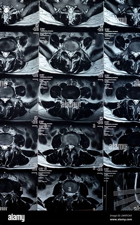 Cairo Egypt December 24 2023 L5 Vertebrae Spinal Laminectomy