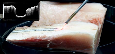 Portable Laser To Help Simplify Spinal Surgery Electro Optics