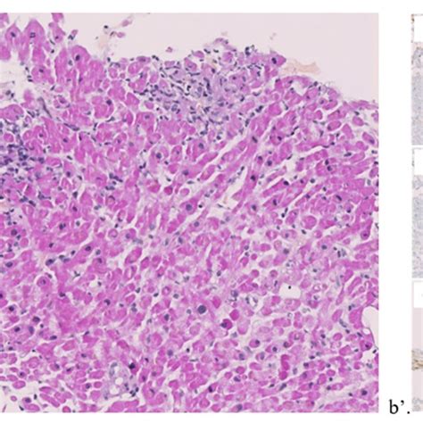 Muscularendomyocardial Biopsies A Right Quadriceps Muscular Biopsy