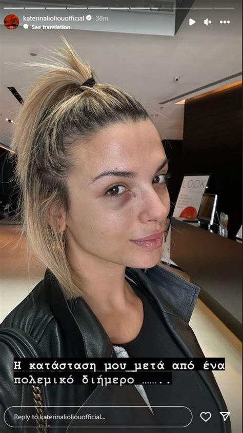 Σε σοκ η Κατερίνα Λιόλιου Η φωτογραφία με μελανιασμένο μάτι μετά το ηλεκτρονικό τσιγάρο που της