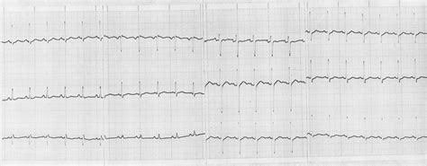 Malignant Ventricular Arrhythmias Due To Aconitum Napellus Seeds