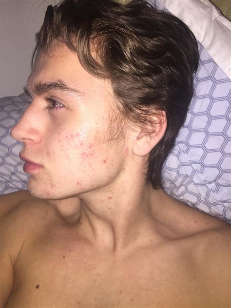 My Acne Is Getting Worse Yet Im Doing Everything To Prevent It What