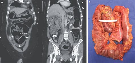 Toxic Megacolon Due To Fulminant Clostridioides Difficile Medizzy