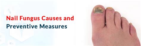 Nail Fungus Causes And Preventive Measures