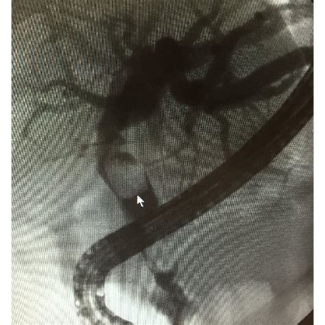 Patterns Of Post Endoscopic Sphincterotomy Bleeding Download Table