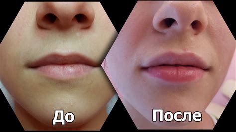 До и после Увеличение губ препаратом Perfectha Derm 1мл Youtube