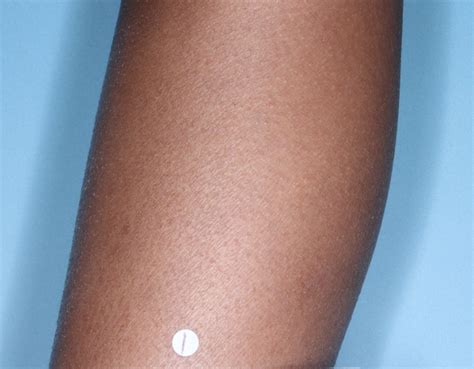 Vtama® Tapinarof Cream 1