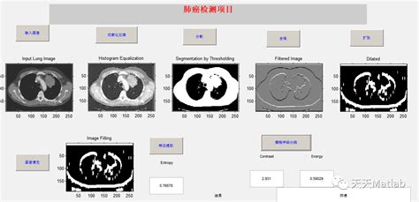 【图像识别】基于神经网络实现肺癌图像识别研究附matlab代码计算机辅助系统在肺癌中的应用代码 Csdn博客