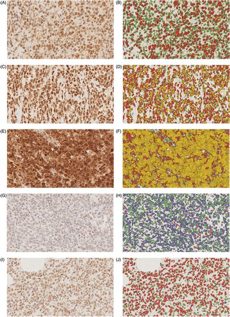 Immunohistochemical Staining Of Formalin Fixed Paraffin Embedded Tumor Download Scientific
