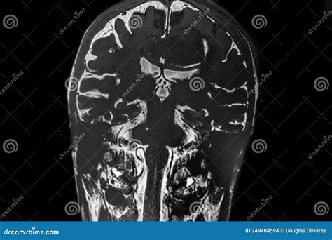 Mri Image Of Cerebral Lesion Located In The Middle Line Parietal