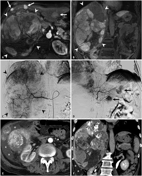 Complications Related To Transarterial Treatment Of Hepatocellular Carcinoma A Comprehensive Review