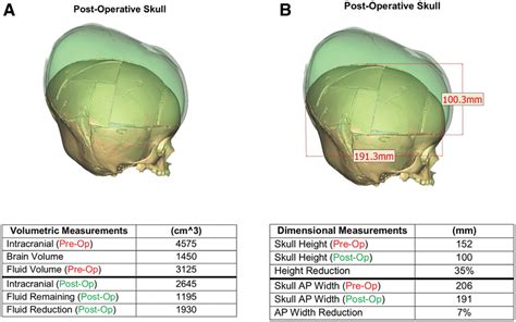 Three Dimensional Ct Scan Reconstructions Demonstrating The Pre And