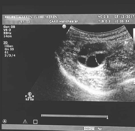 Months After Our Journey Began Our Baby Was Made Same Sex Couples IVF Struggle To Become
