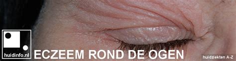 Eczeem Rond De Ogen Oorzaken Uitleg Door Dermatoloog