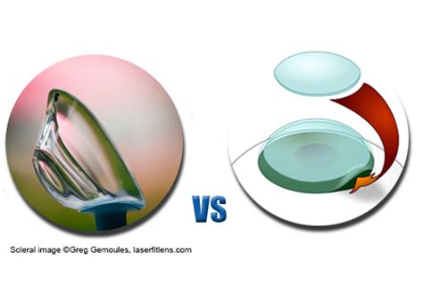 Scleral Lens Reduce Need For Corneal Transplants