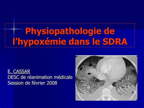 Physiopathologie de lhypoxémie dans le SDRA PDF ETUDE AZ