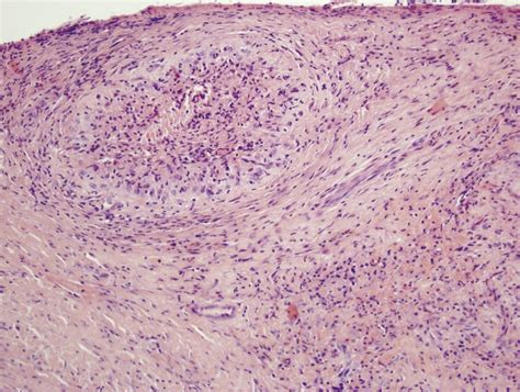 Angiomatoid Nodules Some Of Them Having A Convoluted Outline With
