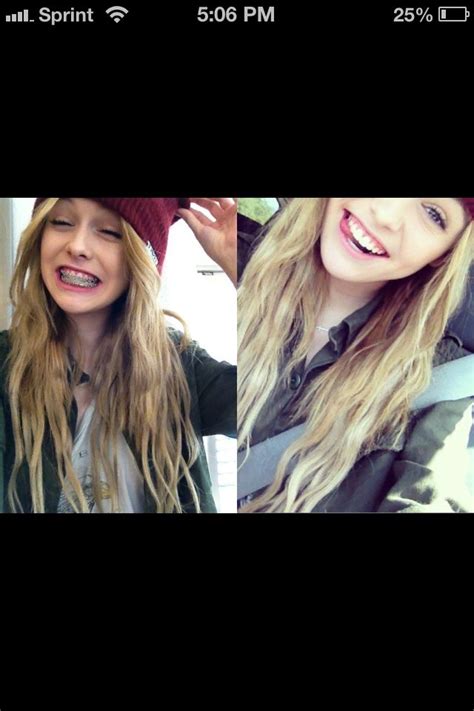 Acacia Clark Braces
