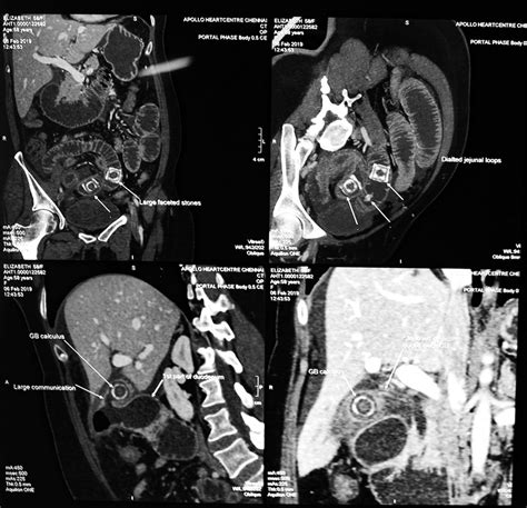 320 Slice Ct Abdomen With Contrast Showing Two Stones Inside The Download Scientific Diagram