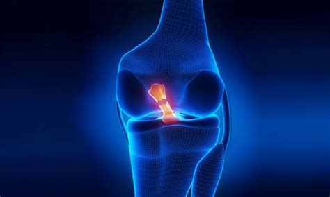 Chondromalacia Patellae Trucure