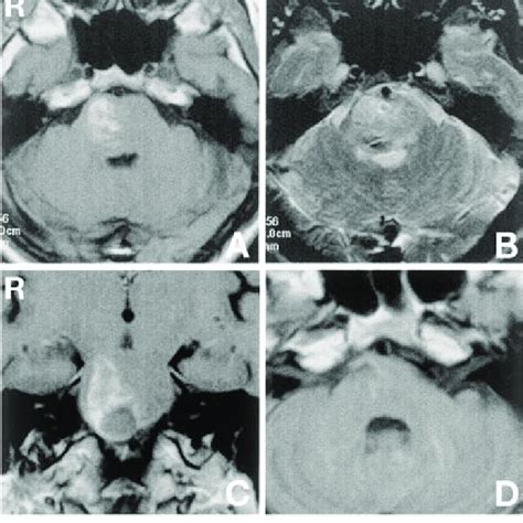 Case 2 A Preoperative Axial T 1 Weighted Magnetic Resonance Mr