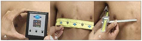 Clinical Experience With Orthotic Repair Of Pectus Carinatum Annals