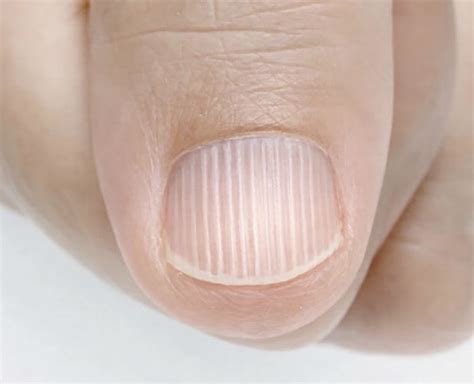 Those Vertical Lines On Your Nails After 40 Heres What Your Body May