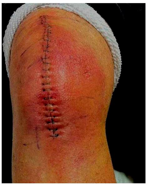 Postoperative Cellulitis After Total Knee Arthroplasty
