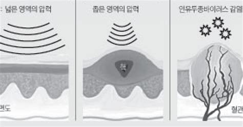 발바닥 굳은살 ‘이렇게 생겼다면 병원 가야