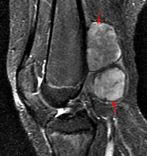 Myositis Ossificans Radsource