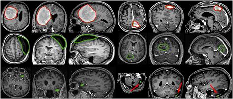 frontiers meningioma segmentation in t1 weighted mri leveraging