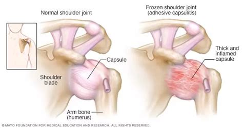 Frozen Shoulder Facts And Treatment Ace Health Centre